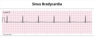 Bradycardia ACLS Algorithm - Safety Training Seminars