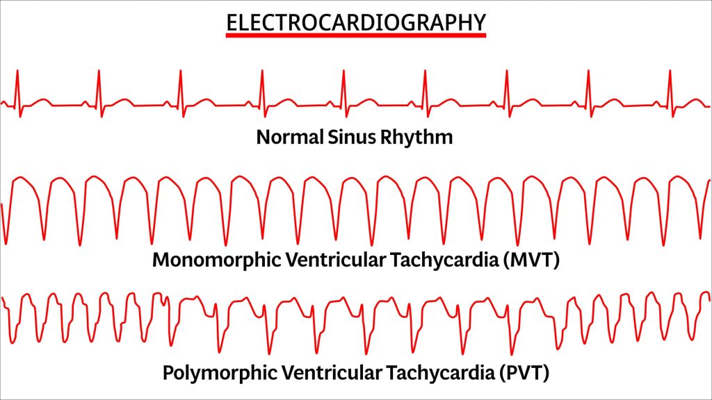 Tachycardia ACLS Algorithm - Safety Training Seminars