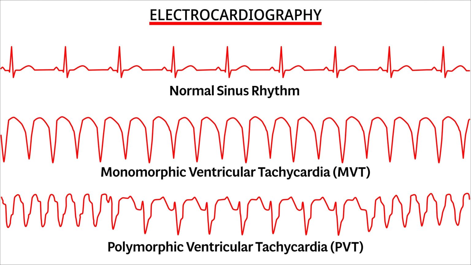 Tachycardia ACLS Algorithm - Safety Training Seminars