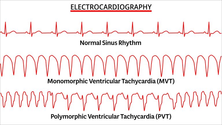 Tachycardia ACLS Algorithm - Safety Training Seminars